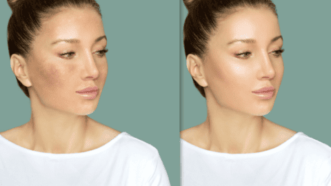 Rimozione macchie cutanee con laser - Chirurgicamente